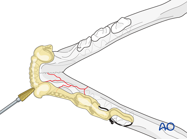 Wire reinforced intraoral splinting for Mandible - Rostral fracture