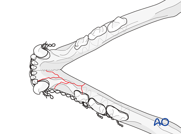 Wire reinforced intraoral splinting for Mandible - Rostral fracture