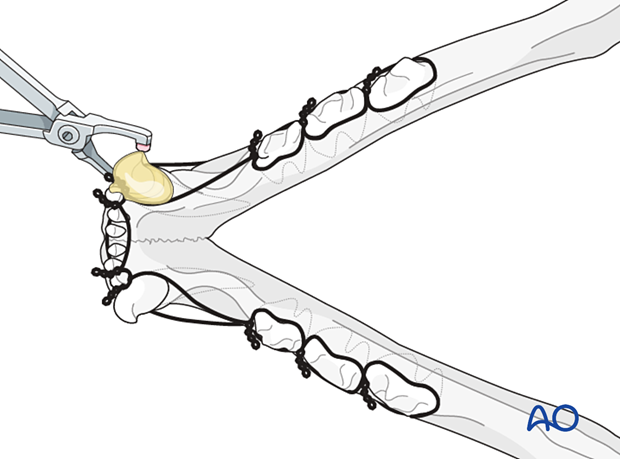 Wire reinforced intraoral splinting for Mandible - Body fracture