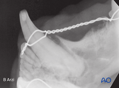 Wire reinforced intraoral splinting for Mandible - Rostral fracture