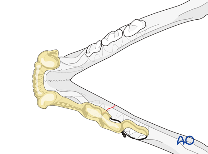 Wire reinforced intraoral splinting for Mandible - Body fracture