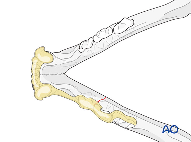 Wire reinforced intraoral splinting for Mandible - Body fracture