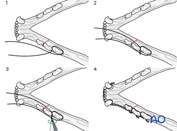 Wire reinforced intraoral splinting for Mandible - Body fracture