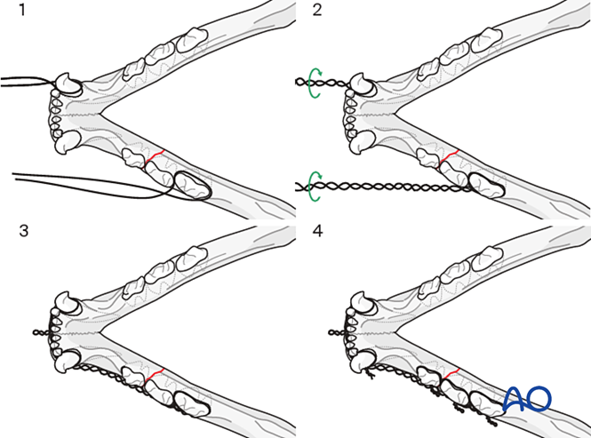 Wire reinforced intraoral splinting for Mandible - Body fracture