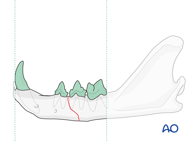 Wire reinforced intraoral splinting for Mandible - Body fracture