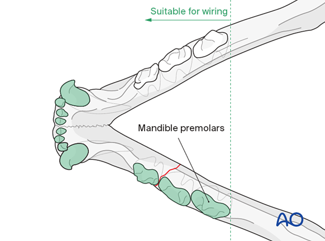 Wire reinforced intraoral splinting for Mandible - Body fracture