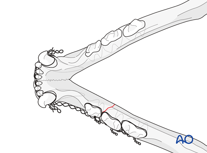 Wire reinforced intraoral splinting for Mandible - Body fracture