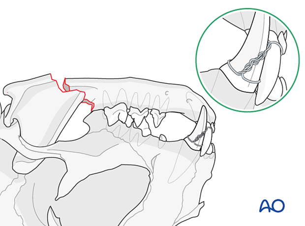 Plate fixation for Mandible - Fractures of the ramus