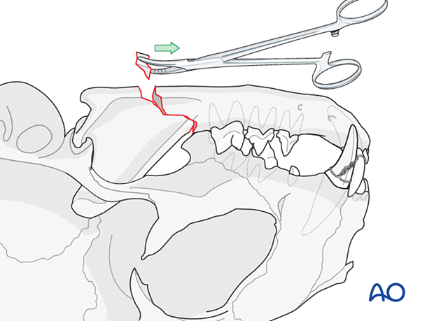 Plate fixation for Mandible - Fractures of the ramus