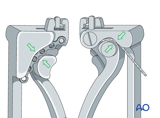Plate fixation for Mandible - Body fracture