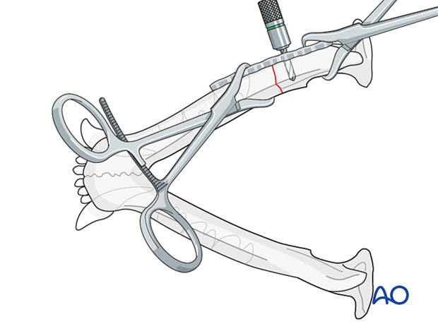 Plate fixation for Mandible - Fractures of the ramus
