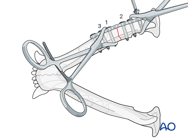 Plate fixation for Mandible - Fractures of the ramus