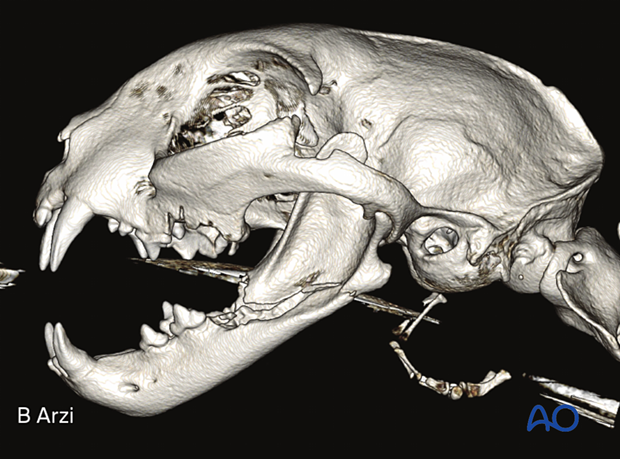 Plate fixation for Mandible - Fractures of the ramus