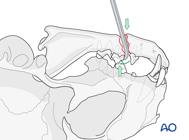 Plate fixation for Mandible - Body fracture
