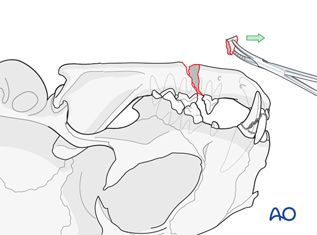 Plate fixation for Mandible - Body fracture