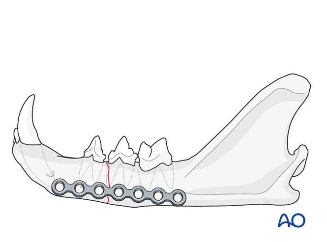 Plate fixation for Mandible - Body fracture