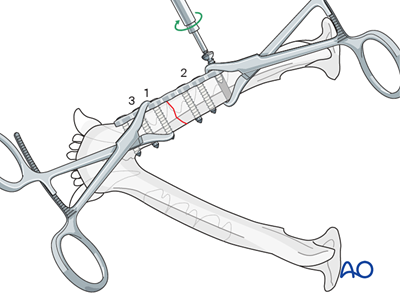 Plate fixation for Mandible - Body fracture