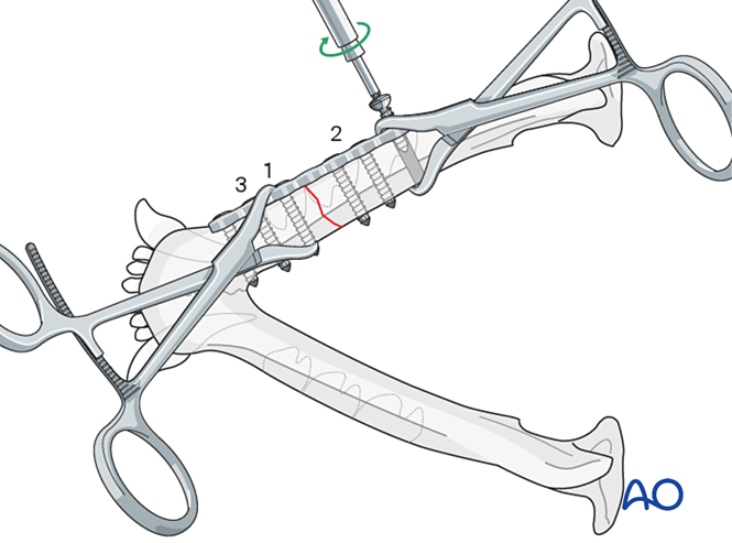 Plate fixation for Mandible - Body fracture