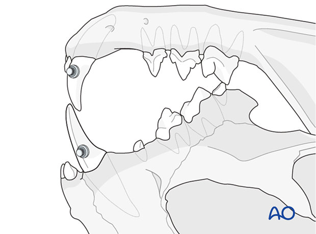 Elastic therapy for Mandible - Temporomandibular joint fracture