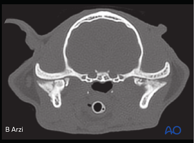 Condylectomy for Mandible - Temporomandibular joint fracture