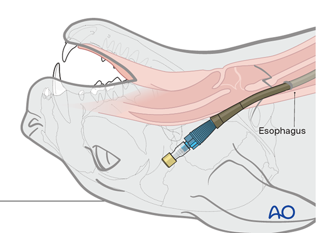 Maxillomandibular fixation (MMF) for Mandible - Fractures of the ramus