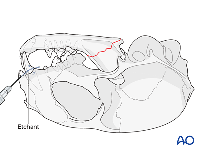 Maxillomandibular fixation (MMF) for Mandible - Fractures of the ramus