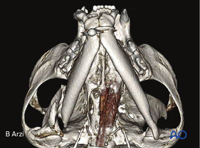 Maxillomandibular fixation (MMF) for Mandible - Fractures of the ramus