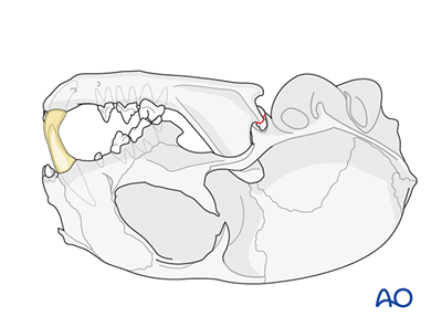 Maxillomandibular fixation (MMF) for Mandible - Temporomandibular joint ...