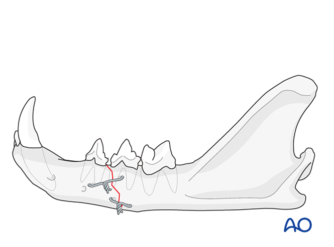 Intraosseous wiring for Mandible - Body fracture