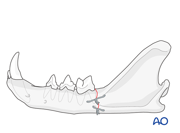 Intraosseous wiring for Mandible - Fractures of the ramus