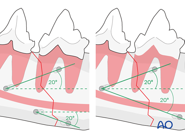 Intraosseous wiring for Mandible - Fractures of the ramus