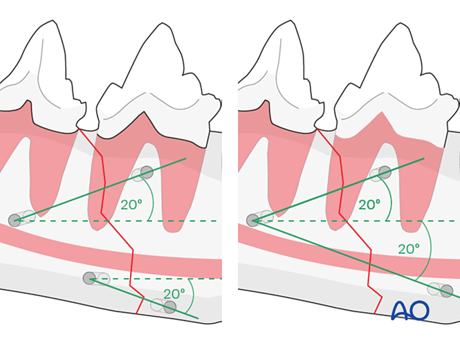 Intraosseous wiring for Mandible - Fractures of the ramus