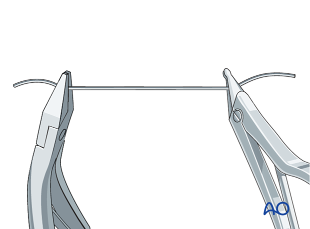 Intraosseous wiring for Mandible - Fractures of the ramus