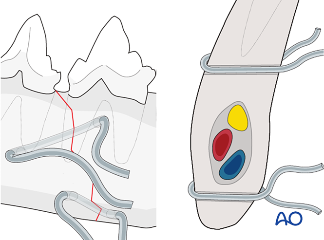 Intraosseous wiring for Mandible - Fractures of the ramus
