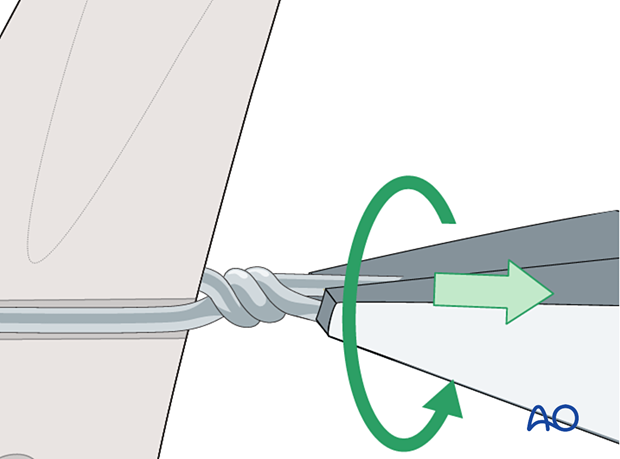 Intraosseous wiring for Mandible - Fractures of the ramus
