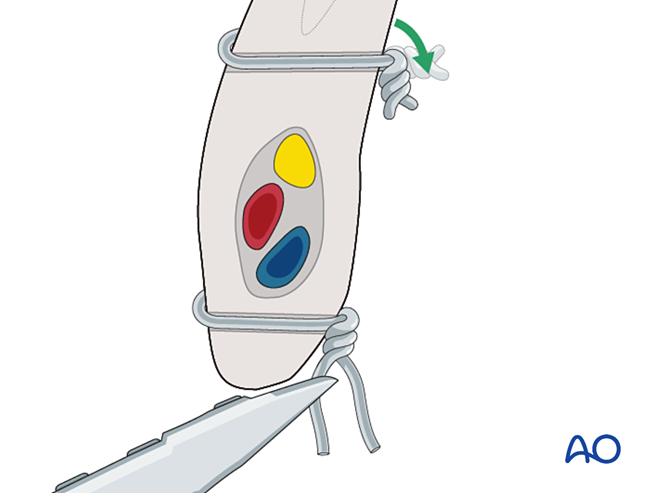 Intraosseous wiring for Mandible - Fractures of the ramus