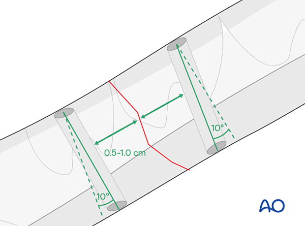 Intraosseous wiring for Mandible - Fractures of the ramus