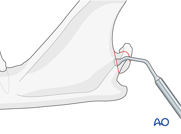 Condylectomy for Mandible - Temporomandibular joint fracture