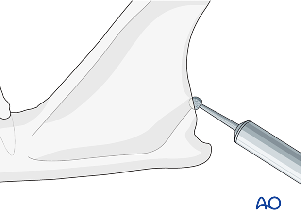 Condylectomy for Mandible - Temporomandibular joint fracture