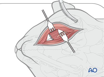 Plate fixation for Mandible - Defect nonunion