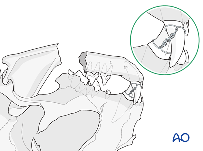 Plate fixation for Mandible - Defect nonunion
