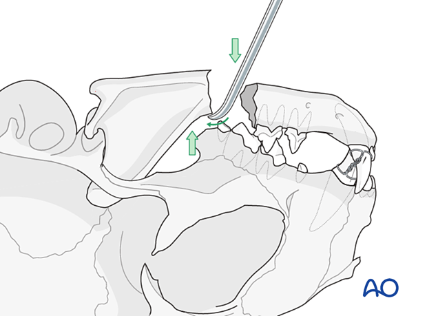 Plate fixation for Mandible - Defect nonunion