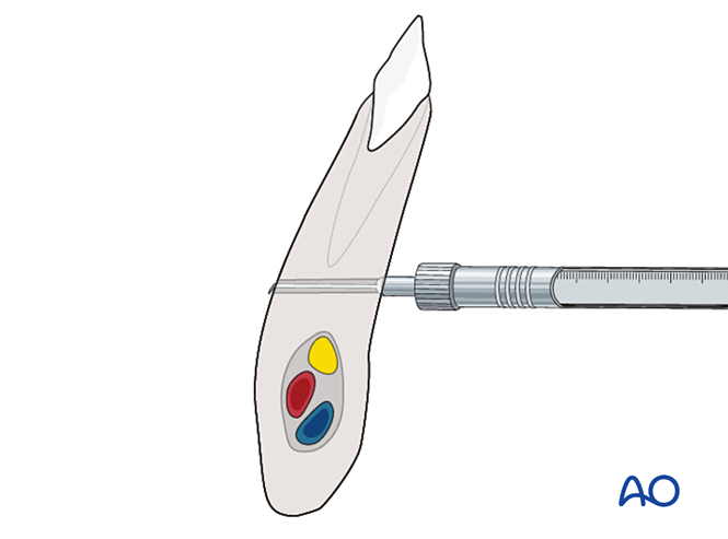 Plate fixation for Mandible - Body fracture
