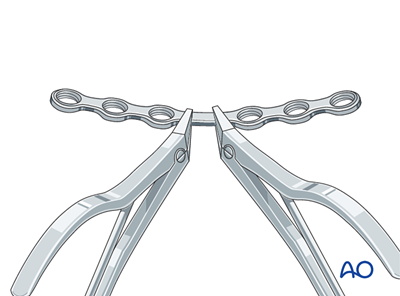 Plate fixation for Mandible - Defect nonunion