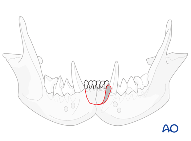 Salvage procedures for Mandible - Rostral fracture