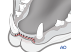 Treatment of Mandible - Rostral fracture