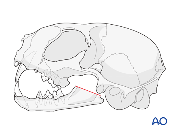 Complications with mandible fractures