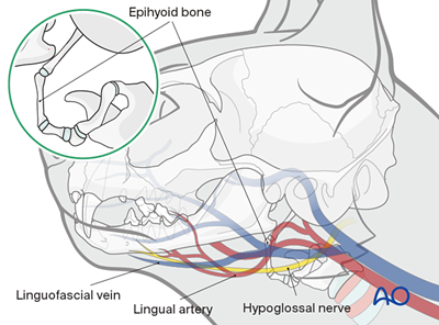 Pharyngotomy intubation