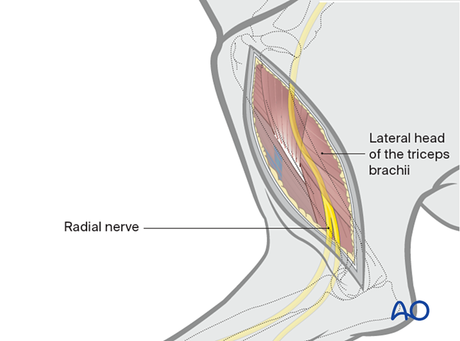 Lateral approach to the dog humeral shaft