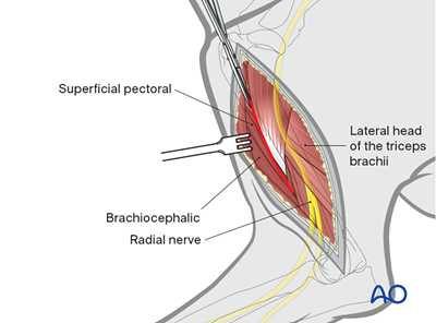 Lateral approach to the cat humeral shaft